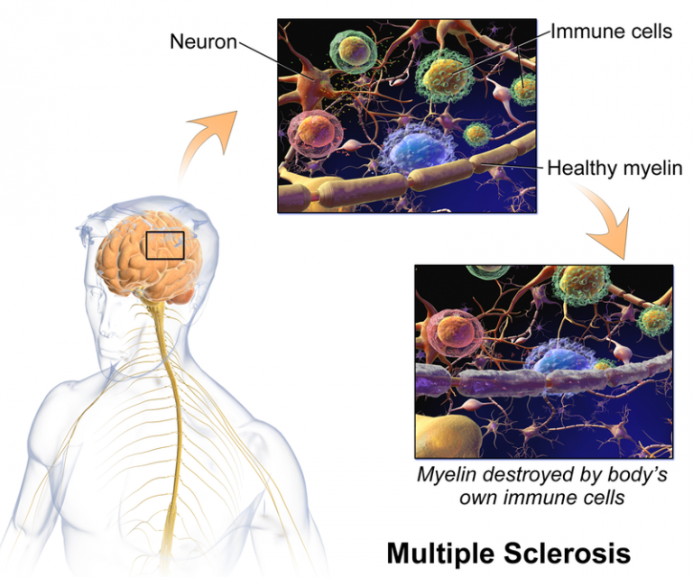 Stem Cell Treatment for Multiple Sclerosis Patients: Destroying Immune ...